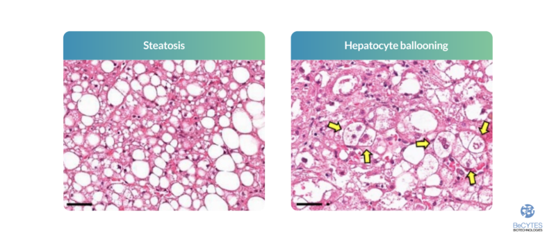 Guide for hepatocyte ballooning: Causes and steatosis comparison